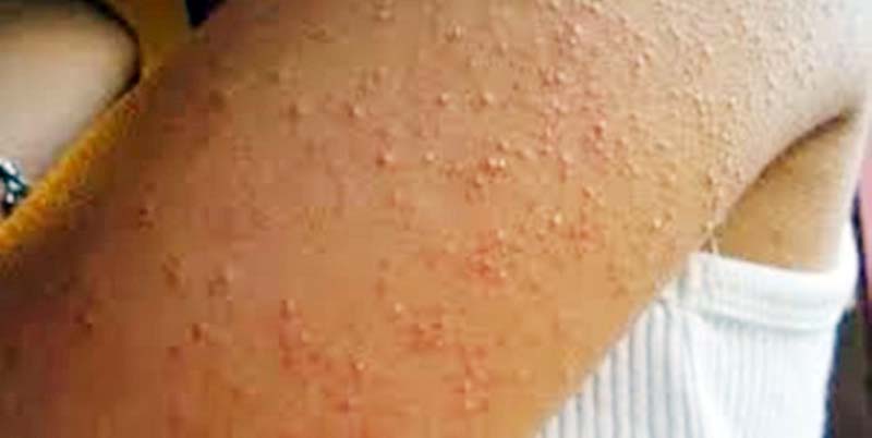 Detectan 40 casos de escabiosis en Nuevo Laredo - Grupo Milenio