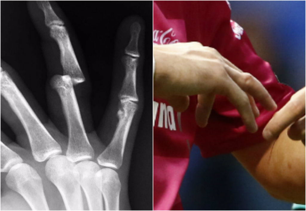 Marchesín, con fractura en el dedo anular