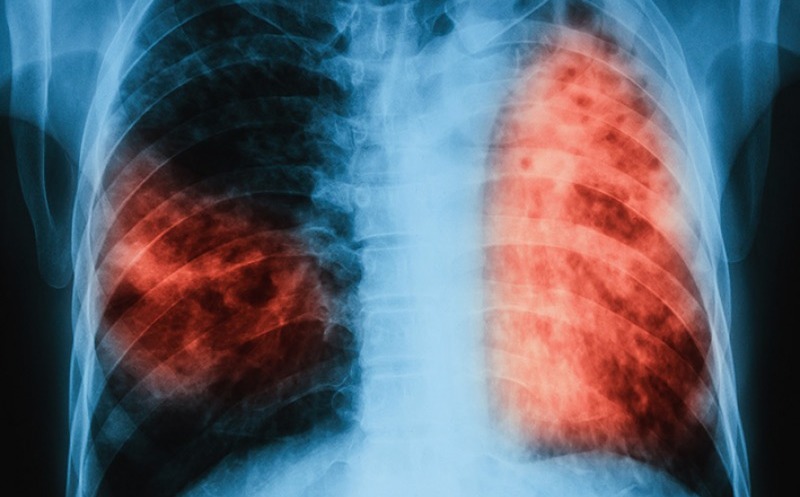 Tuberculosis multirresistente: una amenaza mortal creciente - Grupo Milenio